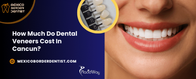 How Much Do Dental Veneers Cost In Cancun?